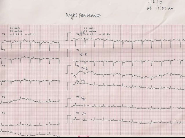An Interesting ECG for Discussion | PPT | Heart and Cardiovascular ...