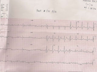 An Interesting ECG for Discussion | PPT | Heart and Cardiovascular ...