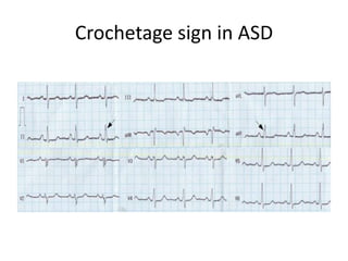 ECG: Congenital Acyanotic HD | PPTX
