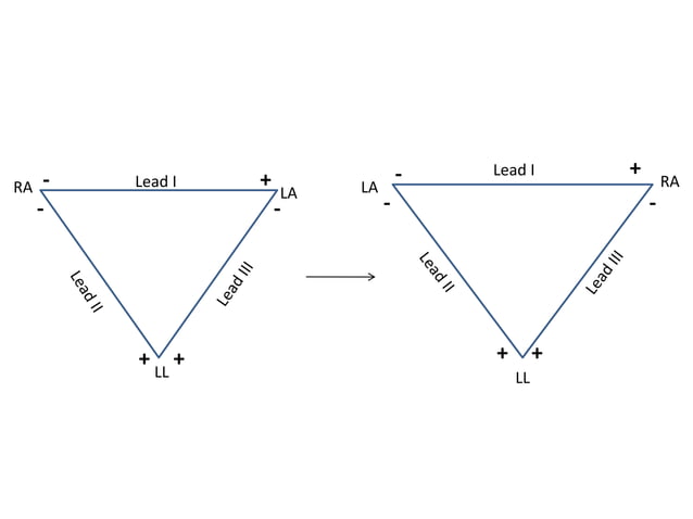 ECG: Reversal of limb leads | PPTX