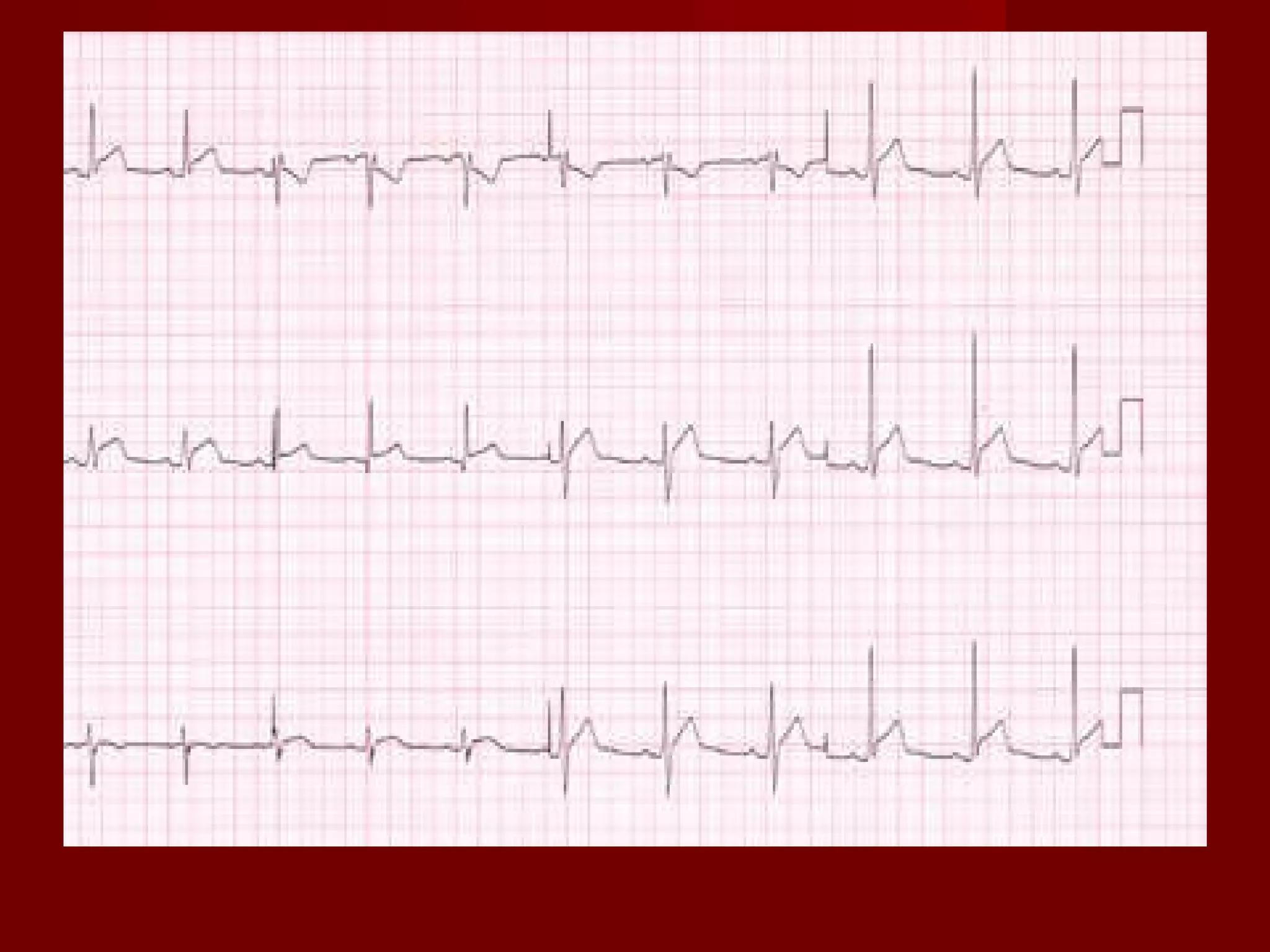 ECG: Pericarditis | PPT