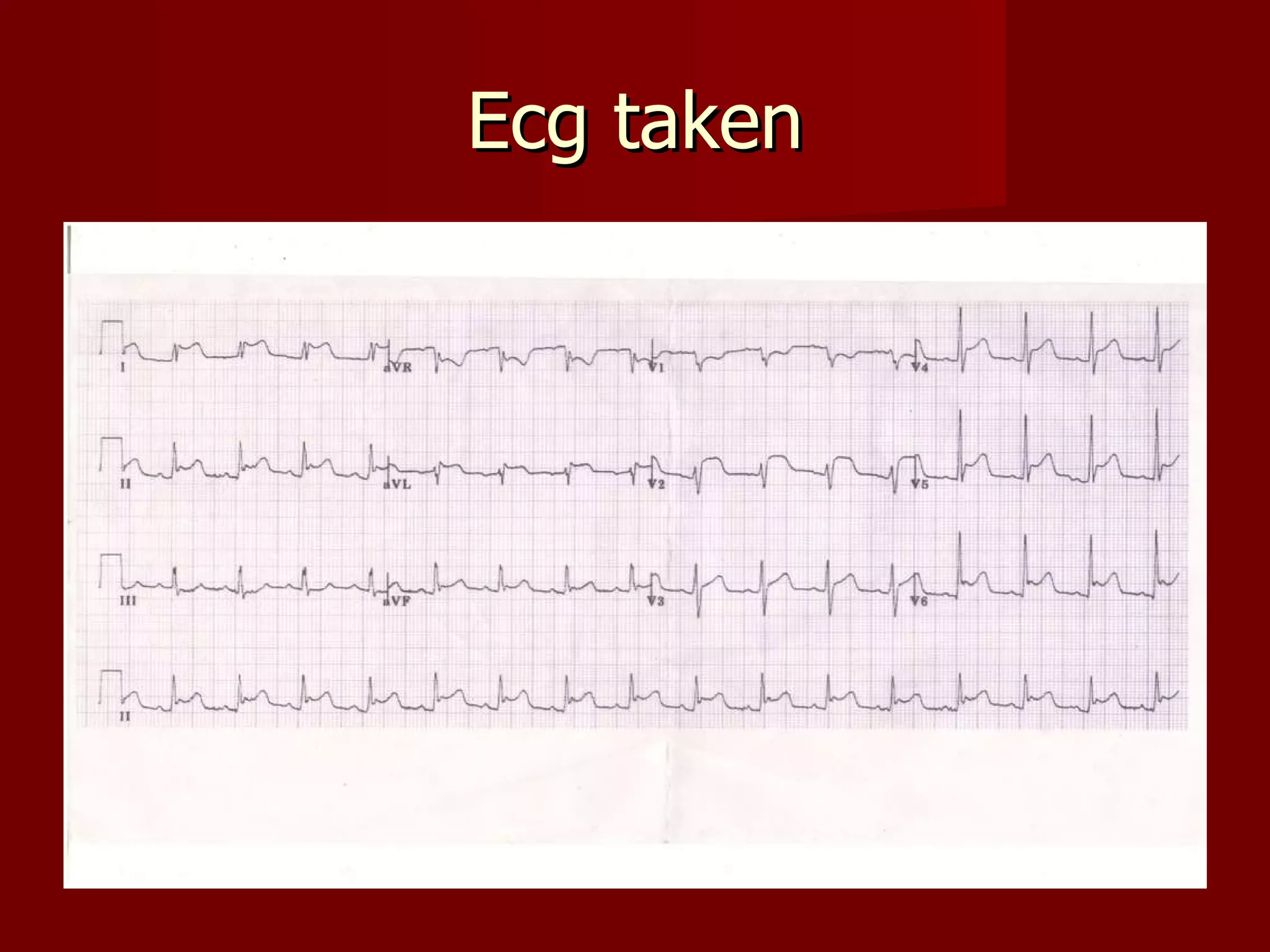 ECG: Pericarditis | PPT