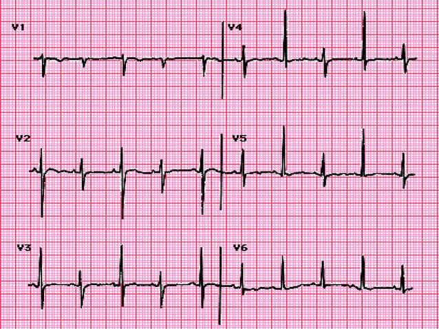 ECG: Pericarditis | PPT | Heart and Cardiovascular Diseases | Diseases ...