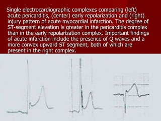 ECG: Pericarditis | PPT
