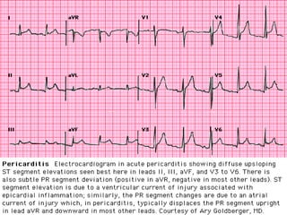 ECG: Pericarditis | PPT