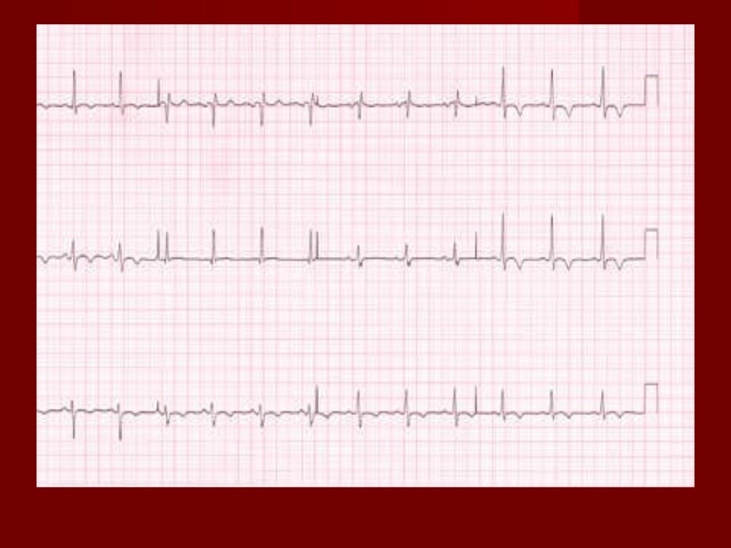 ECG: Pericarditis
