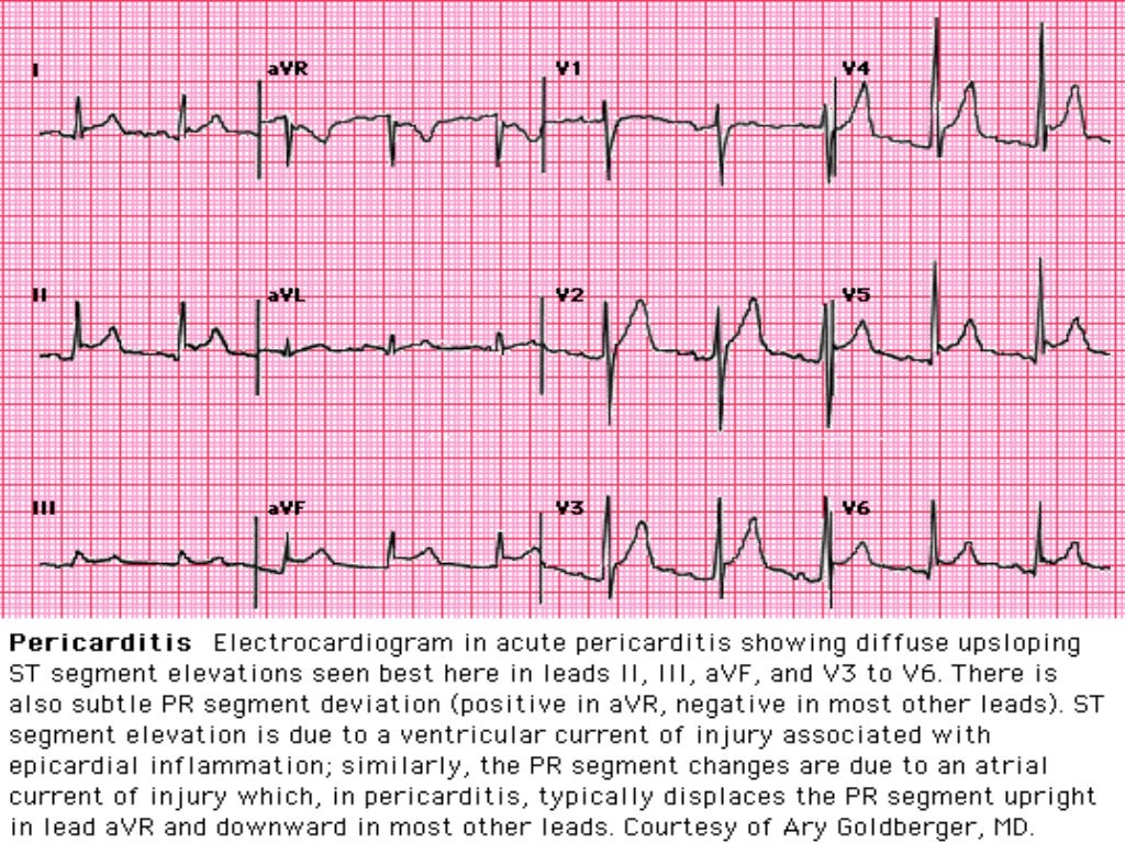 ECG: Pericarditis