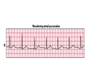 Wandering Atrial Pacemaker Ecg