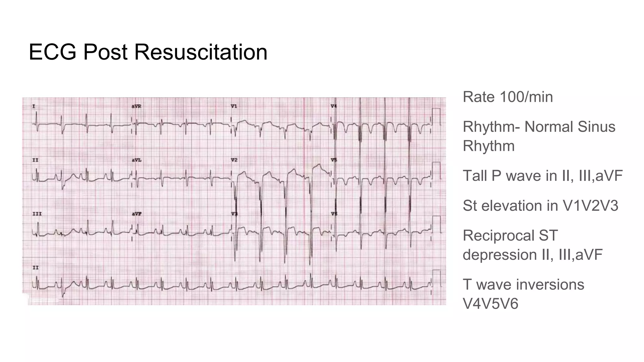 ECG of the weeks | PPTX