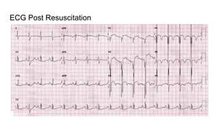 ECG of the weeks | PPTX