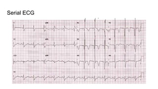 ECG of the weeks | PPTX