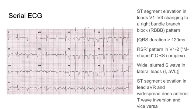 ECG of the weeks | PPTX | Heart and Cardiovascular Diseases | Diseases ...