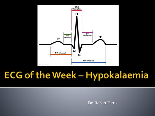 ECG of the Week - Hypokalaemia | PPT