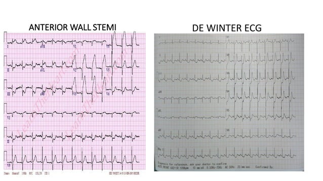 ECG OF THE WEEK - De winters T waves.pptx