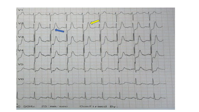 ECG OF THE WEEK - De winters T waves.pptx