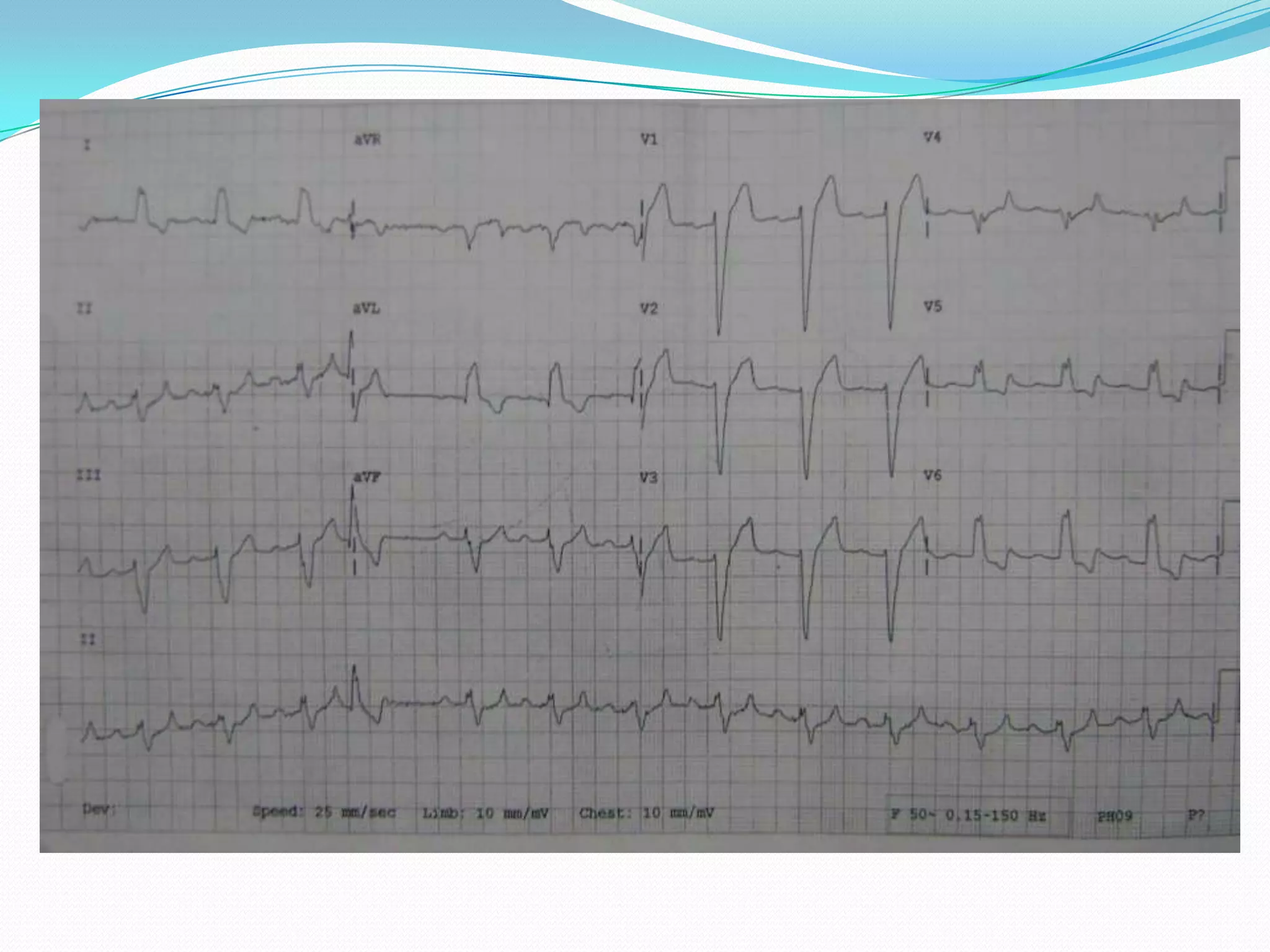 ECG: Trifascicular Block | PPTX