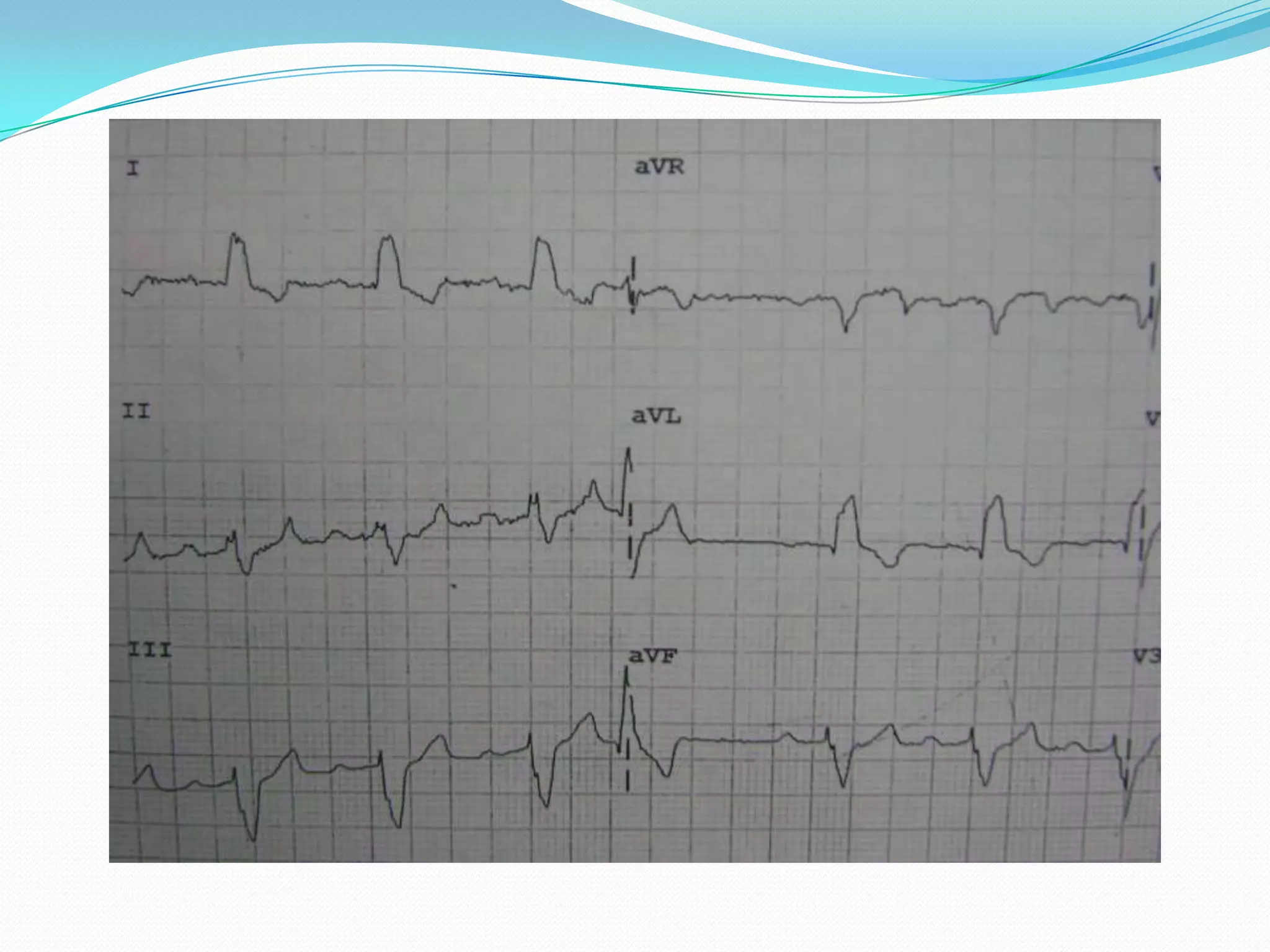 ECG: Trifascicular Block | PPTX