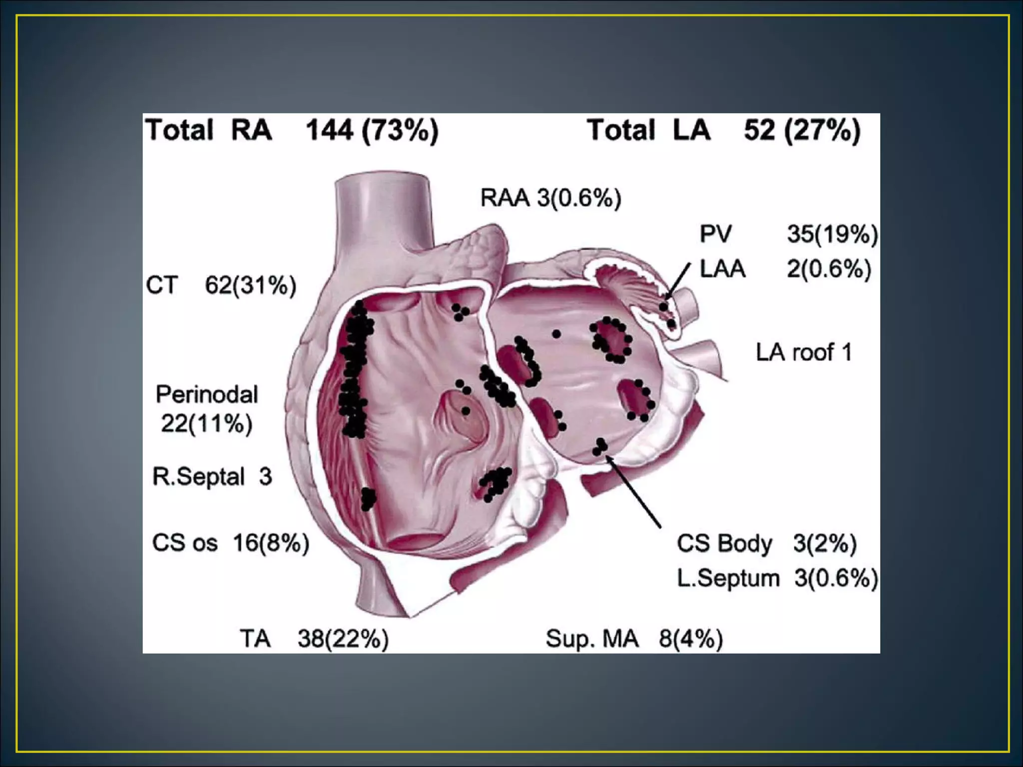 ECG: Atrial Bigeminy | PPT