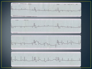 ECG: Atrial Bigeminy | PPT