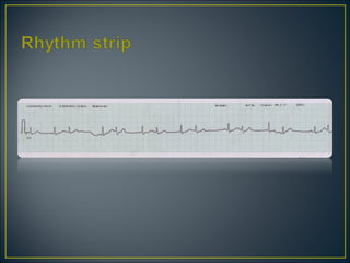 ECG: Atrial Bigeminy | PPT