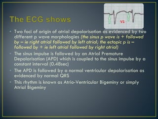 ECG: Atrial Bigeminy | PPT