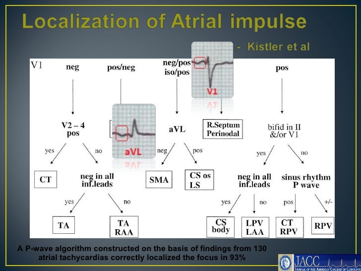 ECG: Atrial Bigeminy