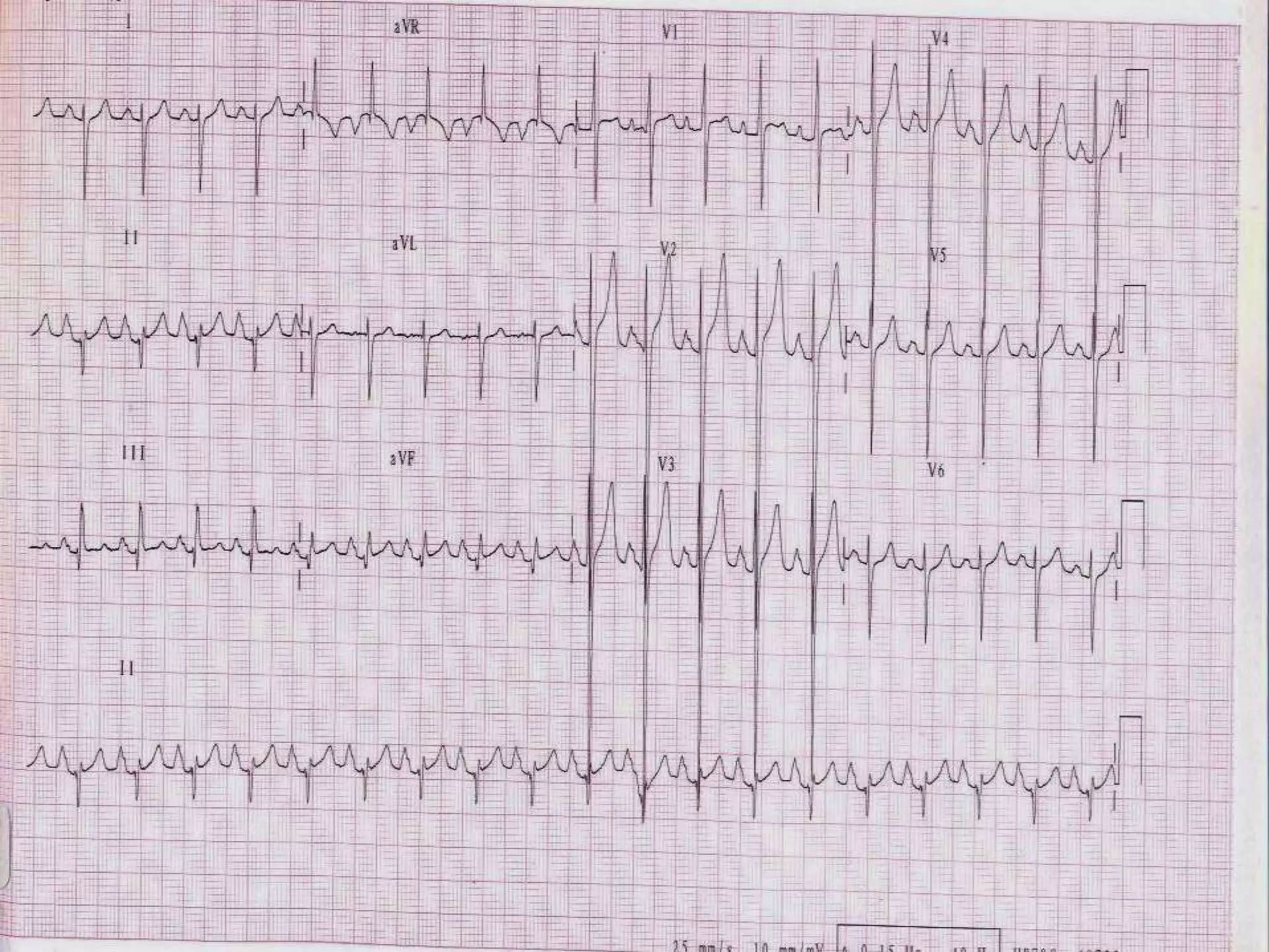 ECG: Congenital Heart Disease | PPTX