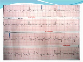 ECG: Crochetage sign | PPT