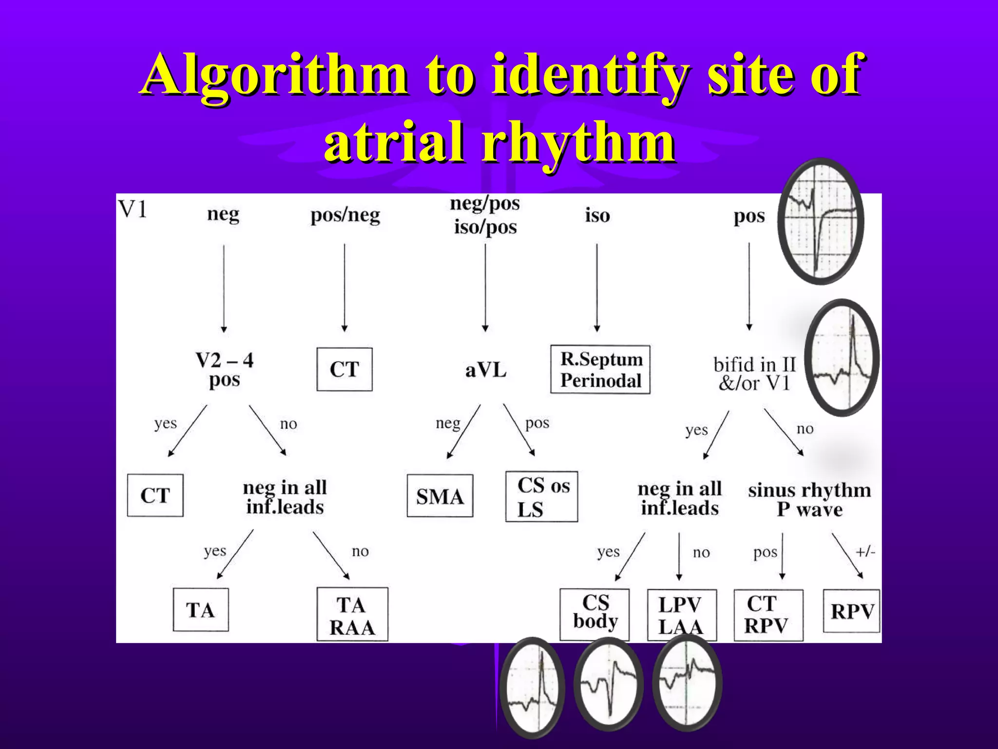 ECG: Coronary Sinus Rhythm | PPT