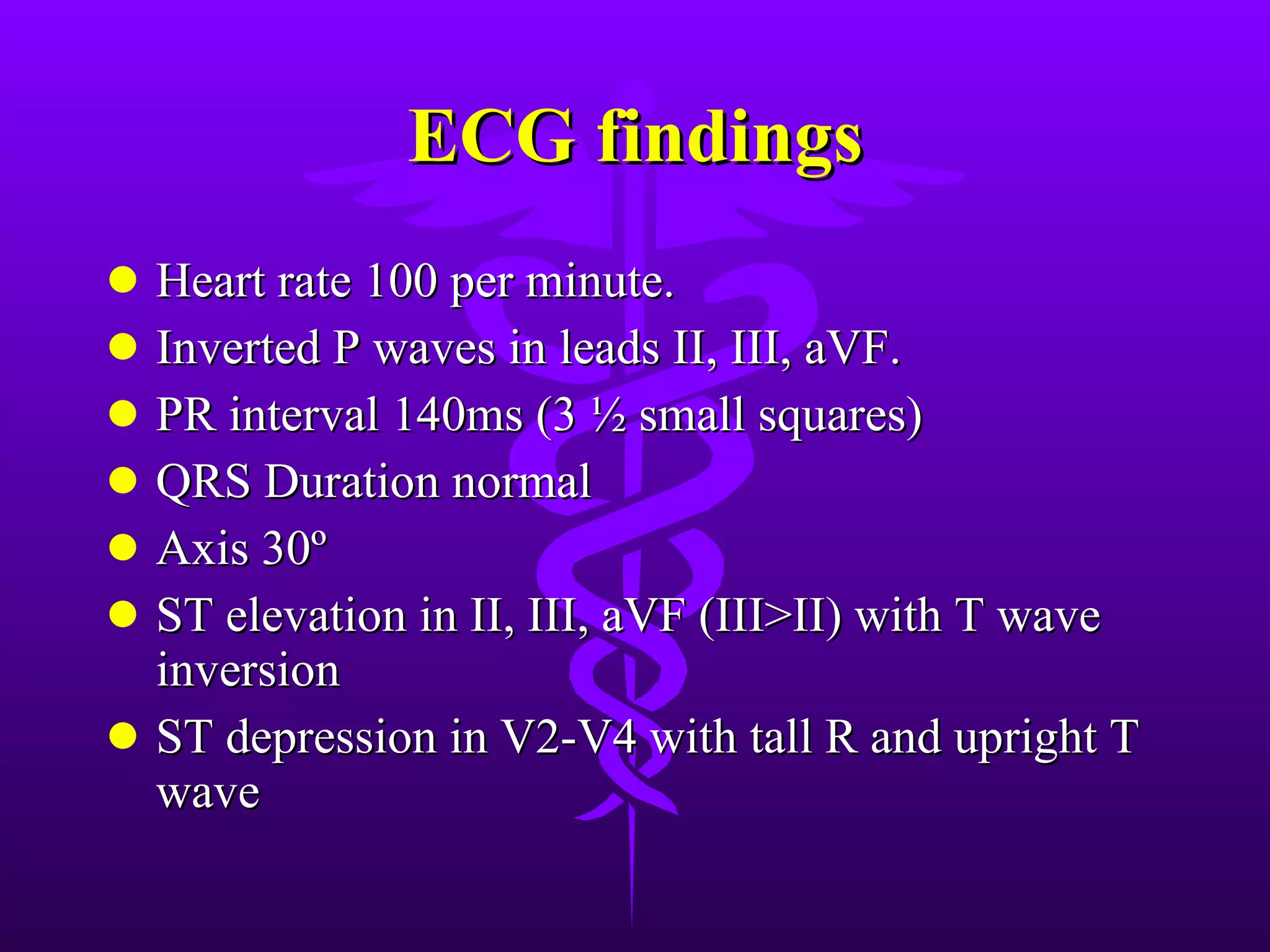 ECG: Coronary Sinus Rhythm | PPT