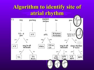 ECG: Coronary Sinus Rhythm | PPT