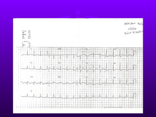 ECG: Coronary Sinus Rhythm | PPT