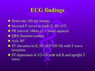 ECG: Coronary Sinus Rhythm | PPT