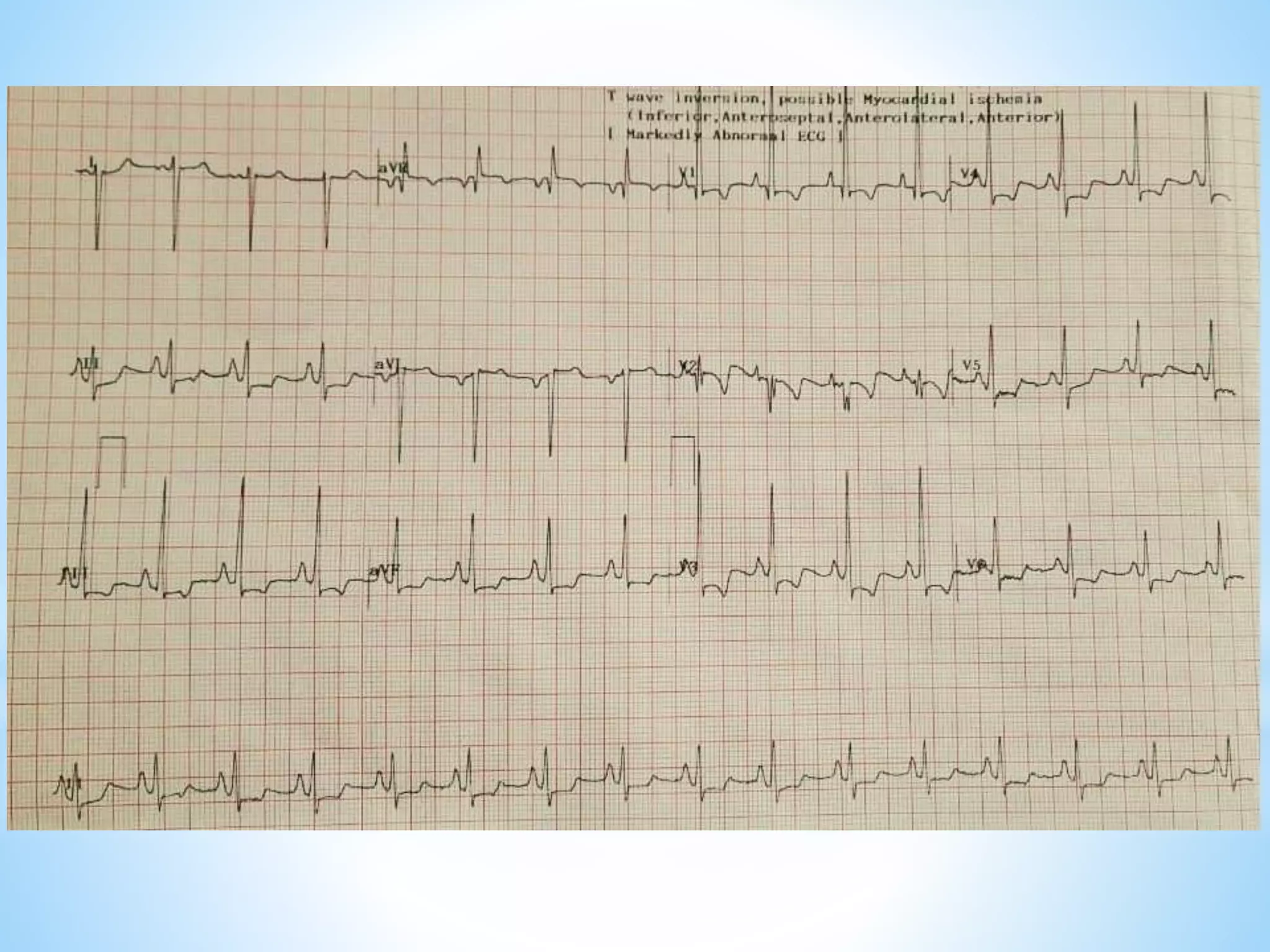 ECG OF THE WEEK final final _114428.pptx
