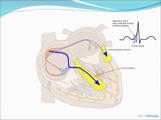 ECG: WPW Syndrome | PPT
