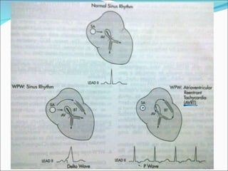 ECG: WPW Syndrome | PPT