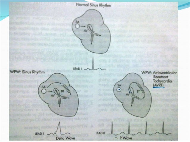 ECG: WPW Syndrome | PPT | Heart and Cardiovascular Diseases | Diseases ...