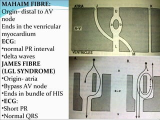 ECG: WPW Syndrome | PPT