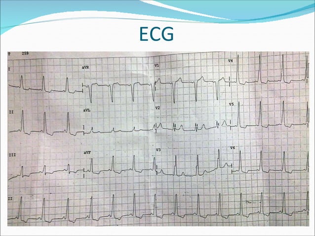 ECG: WPW Syndrome | PPT | Heart and Cardiovascular Diseases | Diseases ...