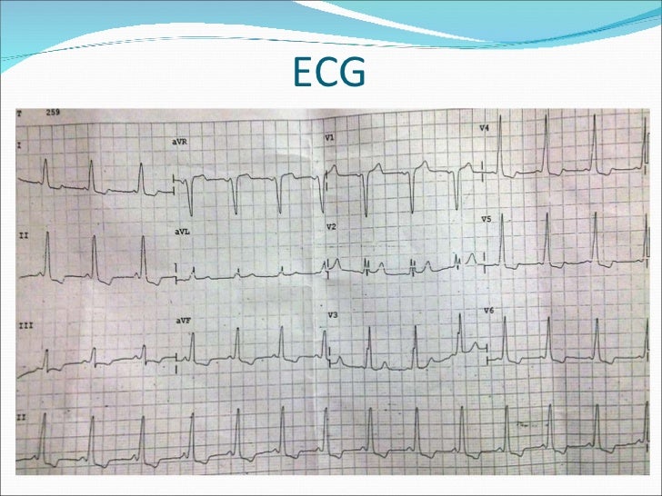 Wpw ecg findings - sekaarchitecture