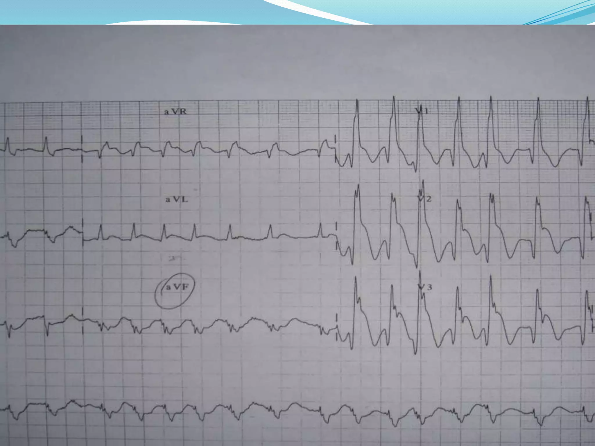 ECG: Bifascicular Block | PPTX