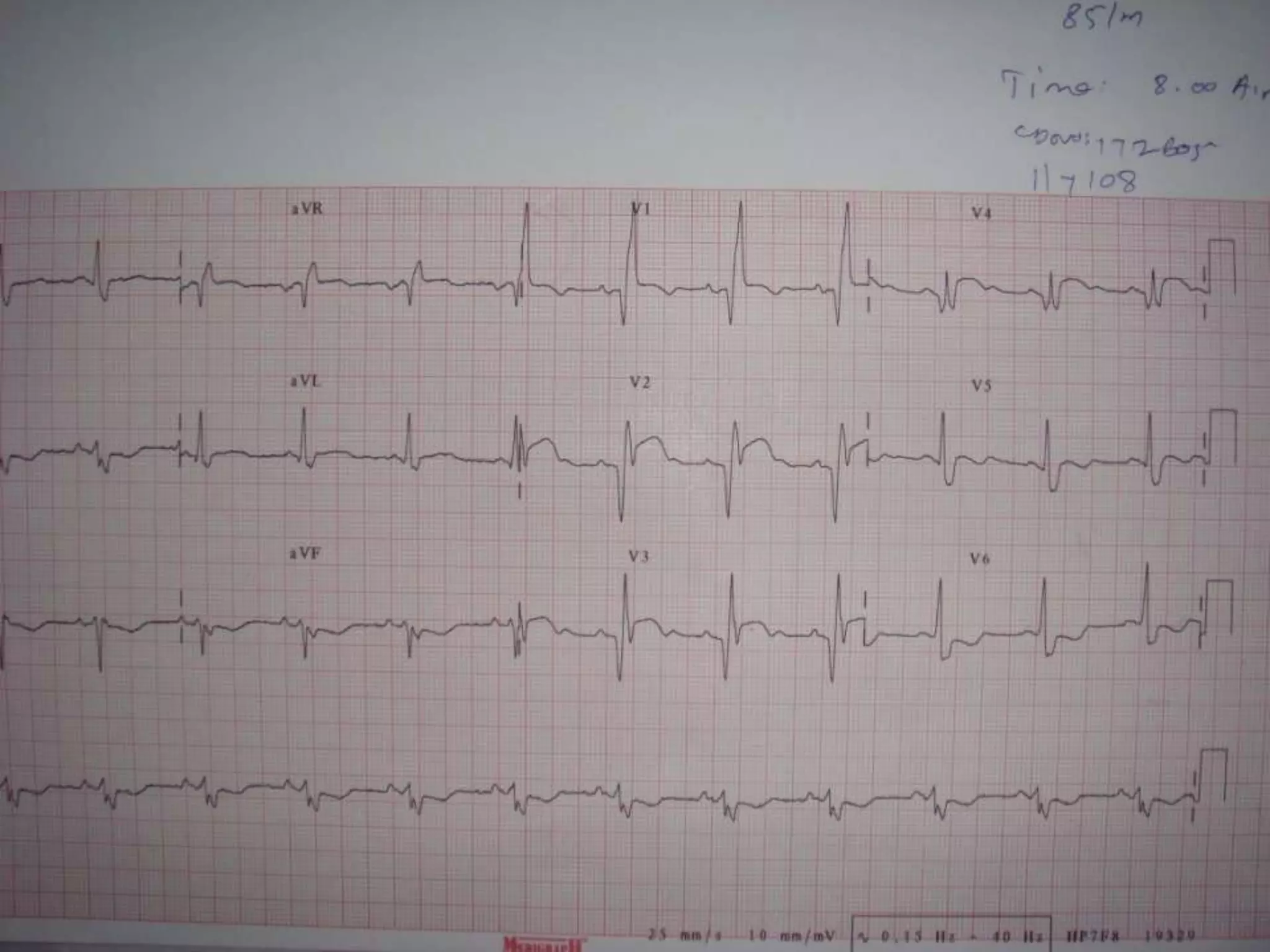 ECG: Bifascicular Block | PPTX