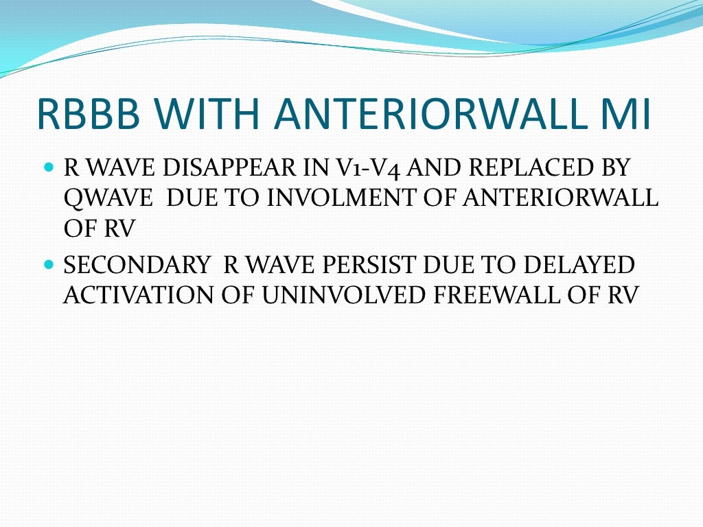 Ecg Bifascicular Block