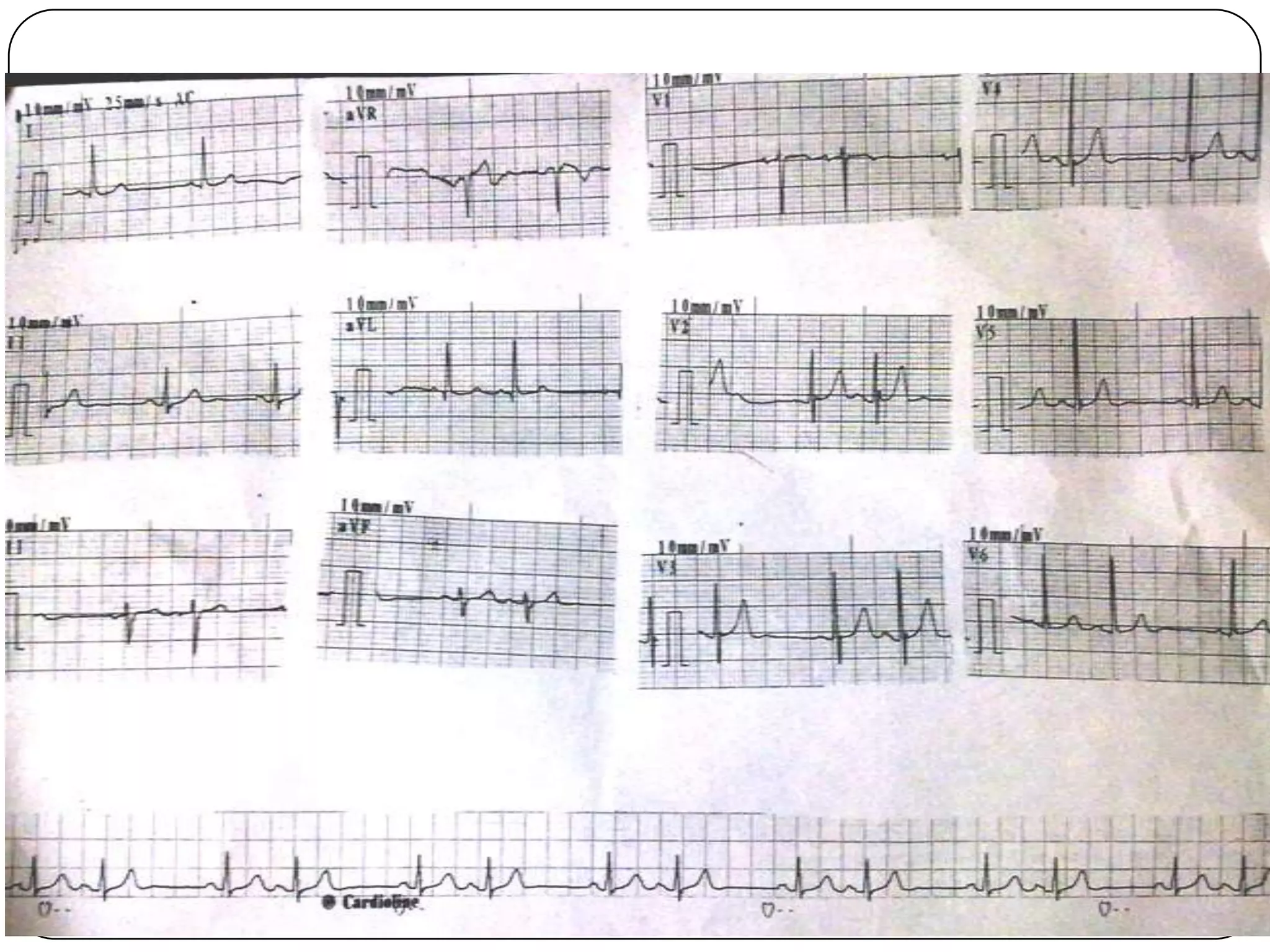 ECG: Atrial Bigeminy | PPT | Heart and Cardiovascular Diseases ...