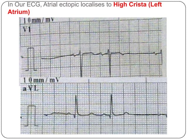 ECG: Atrial Bigeminy | PPT | Heart and Cardiovascular Diseases ...