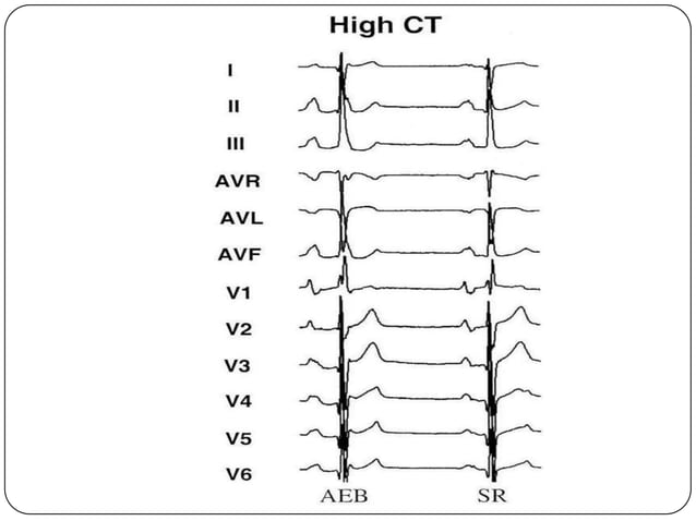 ECG: Atrial Bigeminy | PPT | Heart and Cardiovascular Diseases ...