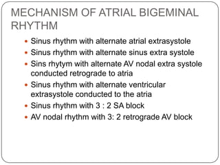 ECG: Atrial Bigeminy | PPT | Heart and Cardiovascular Diseases ...