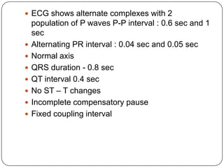ECG: Atrial Bigeminy | PPT