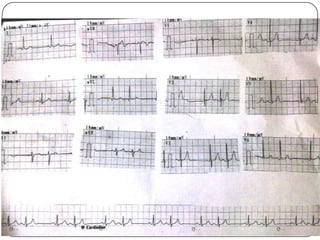 Atrial Bigeminy