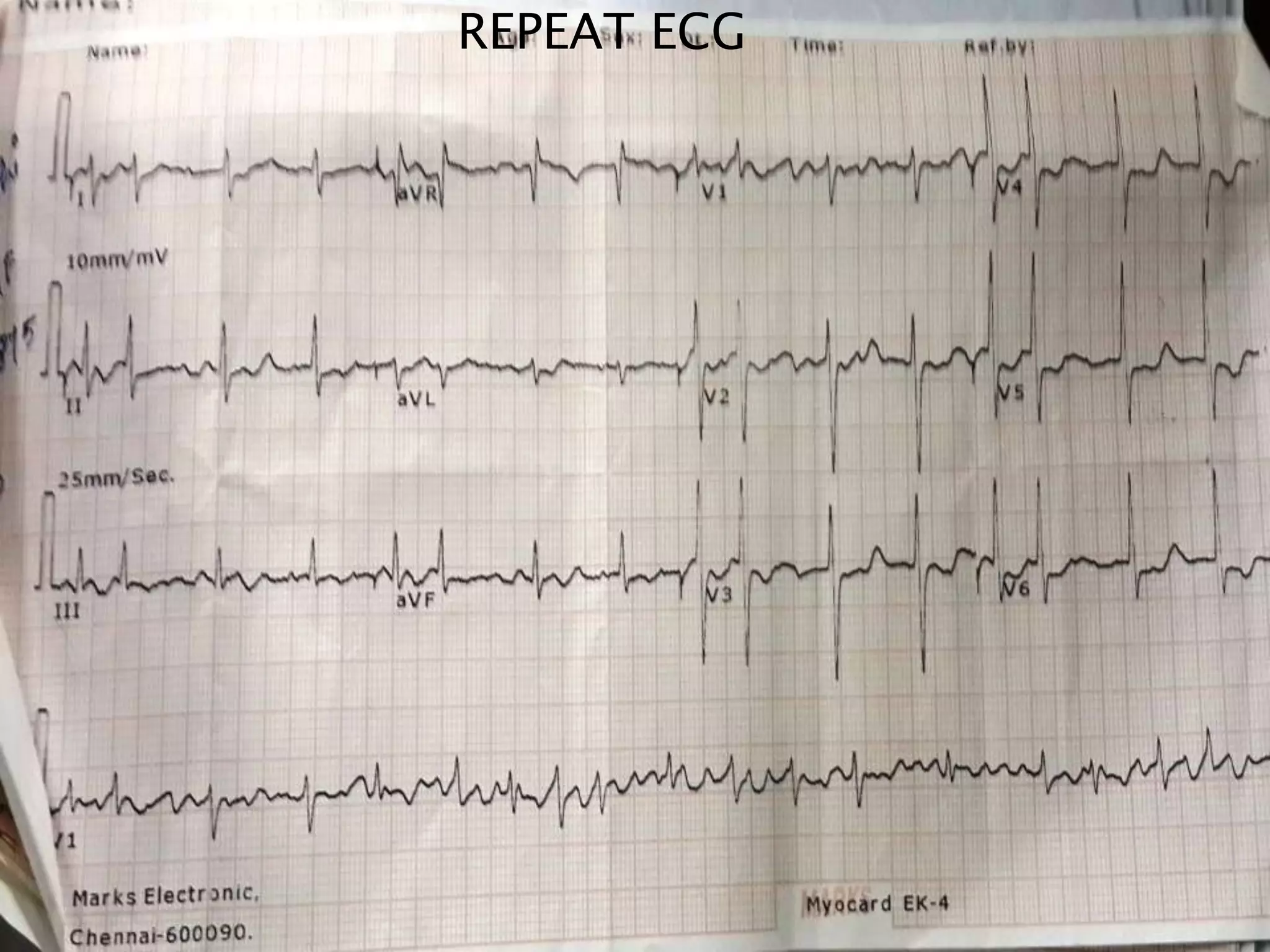 ECG: Digitalis Effect / MAT / AF | PPTX
